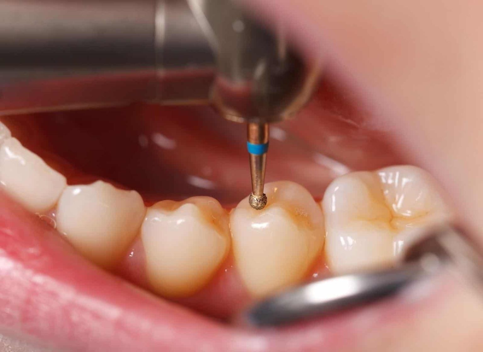 How Long Do Dental Fillings Last? A Complete Guide to Materials ...